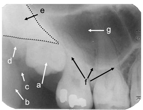 Maxillary Molar Radiograph Diagram Quizlet