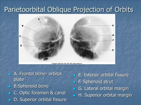Ppt Radiography Of The Orbits Powerpoint Presentation Free Download Id 5669687