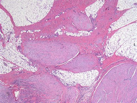 Dermal And Subcutaneous Plexiform Soft Tissue Neoplasms Surgical