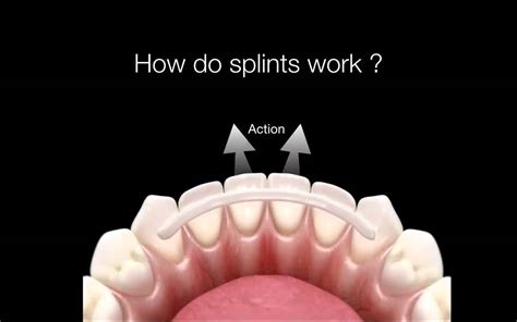 Will Mewing Work If I Have Dental Splints On My Front Teeth Orthotropics