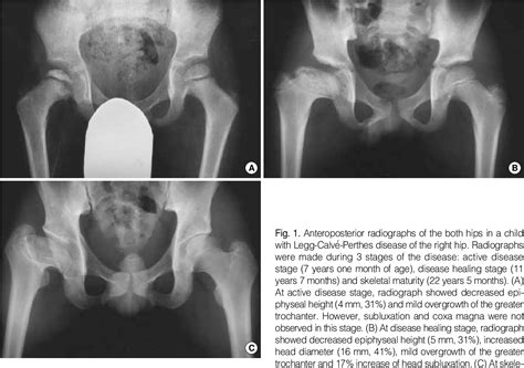 Figure 1 From Femoral Head Deformity In Legg Calve Perthes Disease