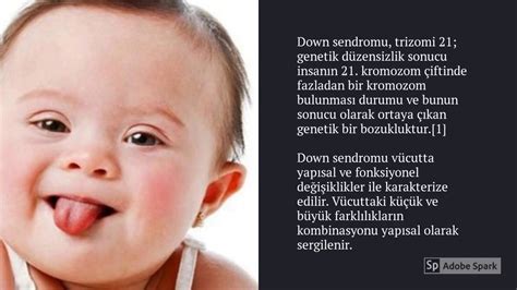 Down Sendromu Youtube