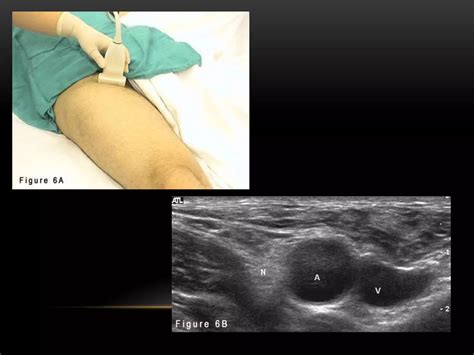 Ultrasound Guided Nerves Block Pptx