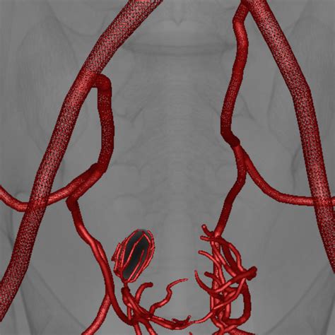 Uterine Artery Embolization Uae Cathi