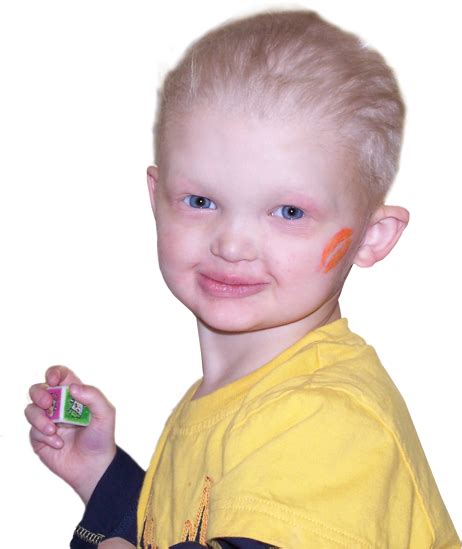 Ectodermal Dysplasia Ectodermal Dysplasia