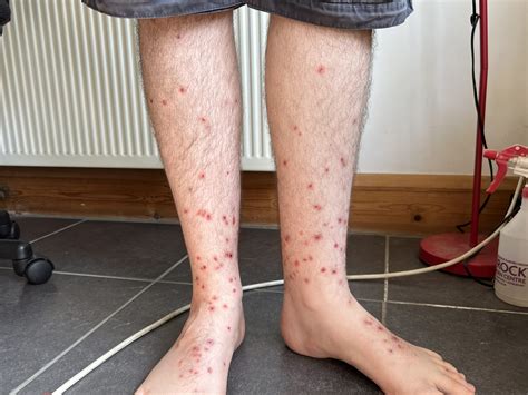 Identifying Bed Bug Bites Characteristics Reactions
