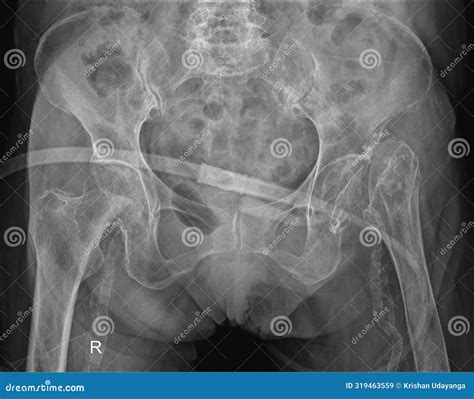 Digital Human Pelvis Radiograph Stock Image Image Of Pelvis Human