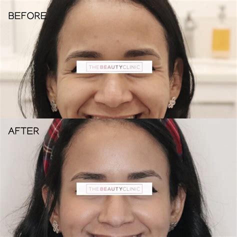 Before And After Botox For Crows Feet The Beauty Clinic
