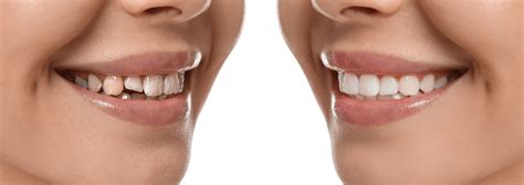 歯列矯正で歯が動きやすい人とは？ 歯が動かないケースも 矯正歯科ネット
