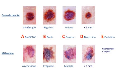 Comment surveiller ses grains de beauté
