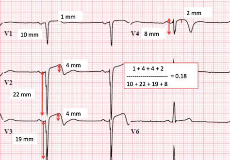 Dr Smith S ECG Blog Is This STEMI No It Is One Of The Most Common Reasons For False Cath Lab