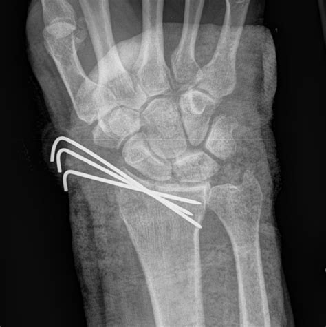 Distal Radius Fracture The Bone School