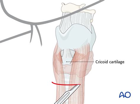 Visor Approach Approach To The Mandible