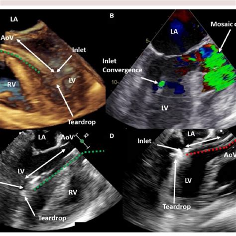 Percutaneous Left Ventricular Assist Device Position On Download