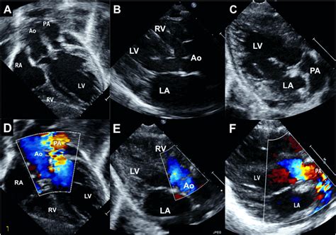 Echocardiogram Of First Patient Movie 1 Subxiphoid Coronal View A Download Scientific Echocardiogram Of First Patient Movie 1 Subxiphoid Coronal View A Download Scientific