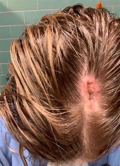 Melanoma Monday A Reminder To Get That Mole Checked Abc News
