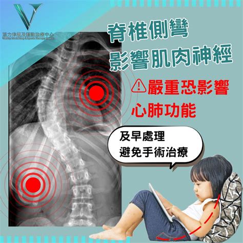 脊柱側彎（scoliosis）是一種脊椎畸形，其中脊柱向一側彎曲，形成s或c形的曲線。嚴重的脊柱側彎可能會對周圍的肌肉和神經產生影響