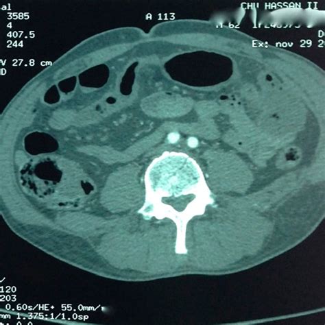 Small Bowel Infarction Download Scientific Diagram