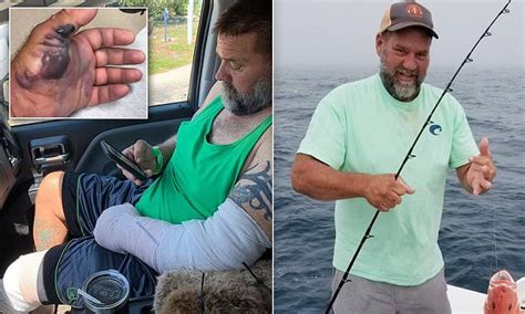 Florida Man Lucky To Be Alive After Contracting A Rare Flesh Eating