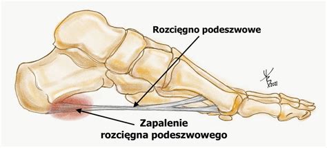 Porady ortopedy Zapalenie entezopatia rozcięgna podeszwowego