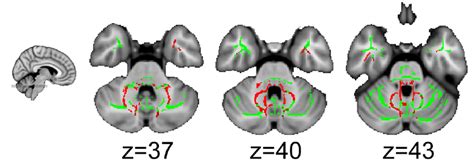 A Result Of Tract Based Spatial Statistics Tbss Mean Fa Skeleton Download Scientific Diagram