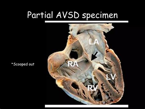 Atrioventricular Septal Defect Ppt