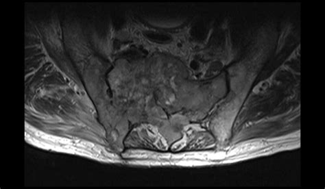 Sacral Metastases Tumours Mri Radiology Article On Sacral Metastases