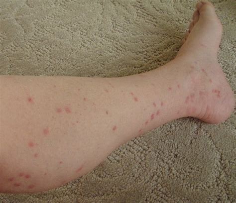 Bed Bug Bites Vs Chicken Pox Moreoo