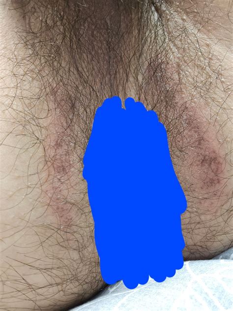 사진주의똥꼬 옆 상처 땀띠 지식in