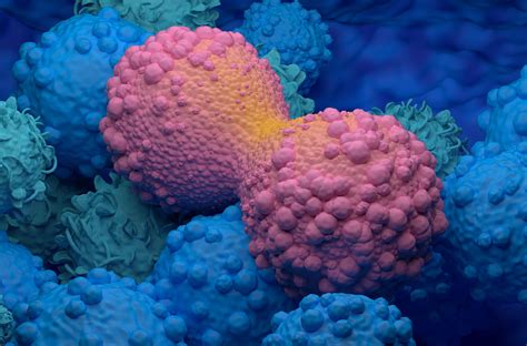 Keynote 522 Trial Results Show Neoadjuvant Keytruda Plus Chemo Improves Overall Survival In