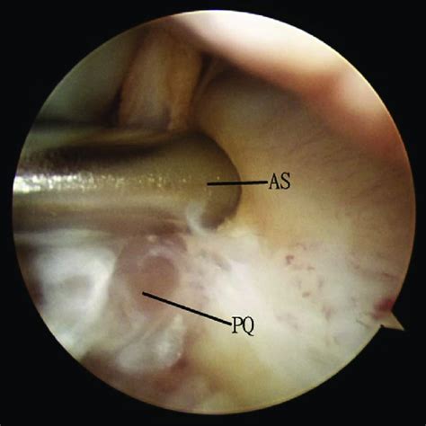 Endoscopic Resection Of Peroneus Quartus Pq Of Left Ankle The Download Scientific Diagram