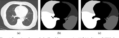 Figure 4 From Detection And Classification Of Bronchiectasis Based On Improved Mask Rcnn