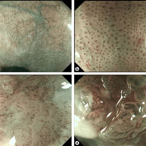 A Patient With Superficial Esophageal Squamous Cell Carcinoma Limited