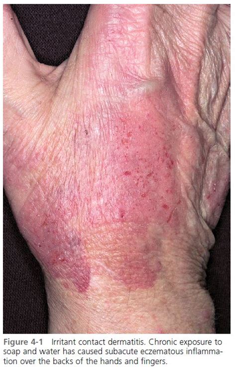 Photoallergic Contact Dermatitis Face