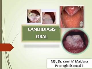 Candidiasis Oral Pptx