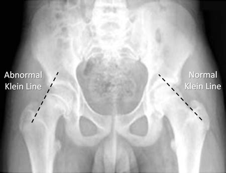 Slipped Capital Femoral Epiphysis Symptoms Diagnosis And Treatment