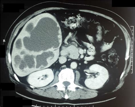 Breve Historia Del Absceso Hepático Amebiano Con Un Caso Ilustrativo