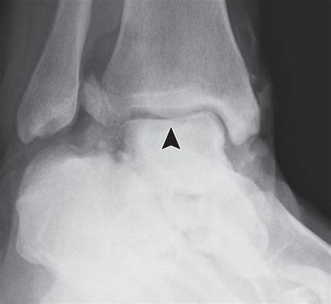 Talus Fracture X Ray At Kate Gask Blog