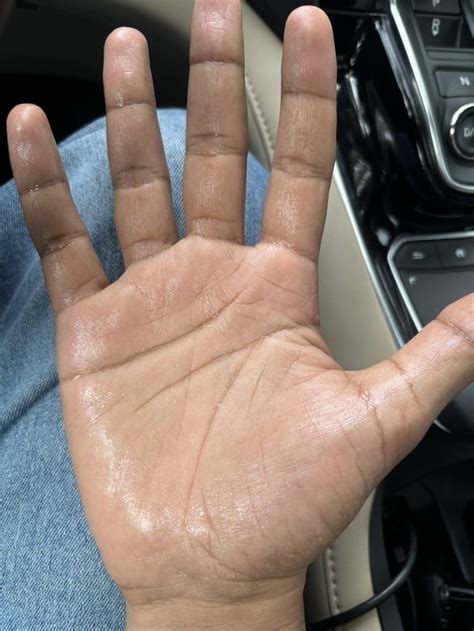 Humid Days Hit Different Rhyperhidrosis