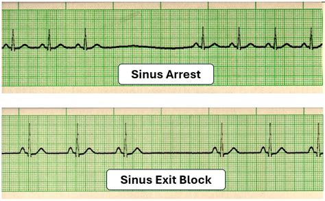 Ekg Detective Sinus Arrest Vs Sinus Exit Block