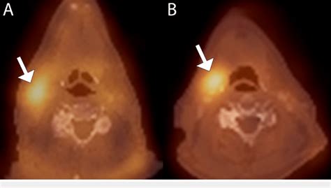 False Positive Interpretation In A 62 Year Old Male With Right Tonsil Download Scientific