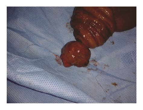 Macroscopic Appearance Of The Resected Specimen Showing A 3 Cm