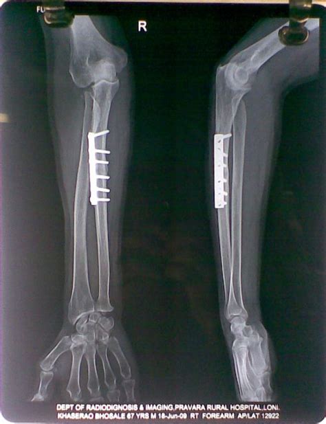 Phrenic Nerve Palsy After Supraclavicular Brachial Plexus Block Pdf Download Available