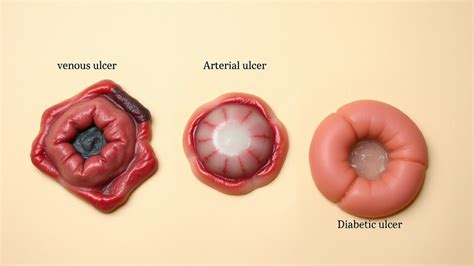 5 Key Differences Venous Ulcer Vs Arterial Ulcer Vs Diabetic Ulcer Diabetes Diet Life