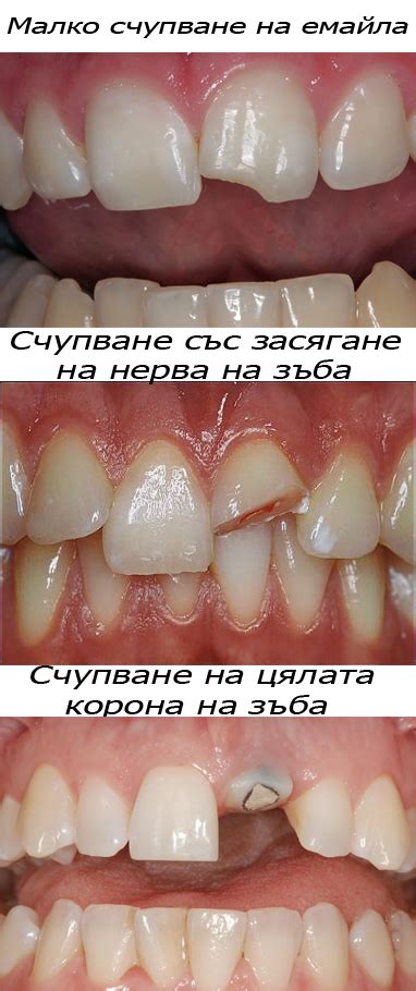 Лечение при счупени или изтрити зъби Д р Ралев зъболекар