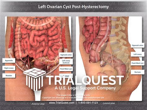 Ovary And Appendix Location