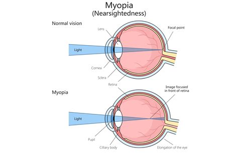 Astigmatism Vs Myopia Whats The Difference