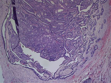 Atlas Of Breast Cancer Early Detection