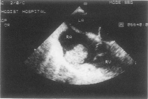 Transesophageal Echocardiogram Demonstrating Right Atrial Pedunculated