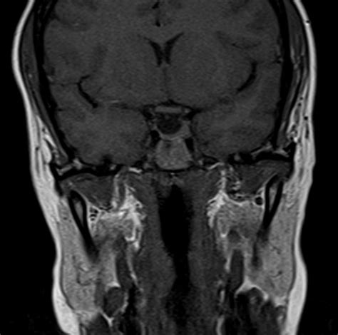 Mri Trigeminal Nerve Coronal T1 Image